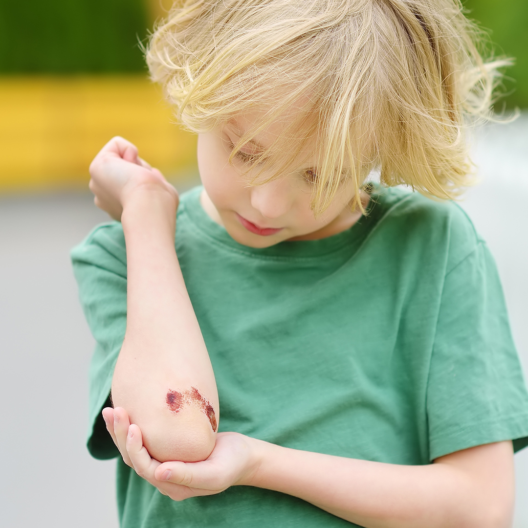 Cómo curar las heridas en niños